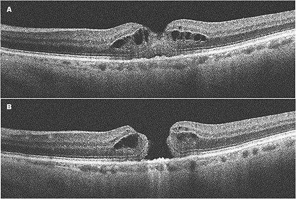 Retinal Physician | PentaVision