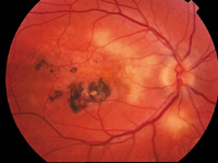 Retinal Physician | PentaVision