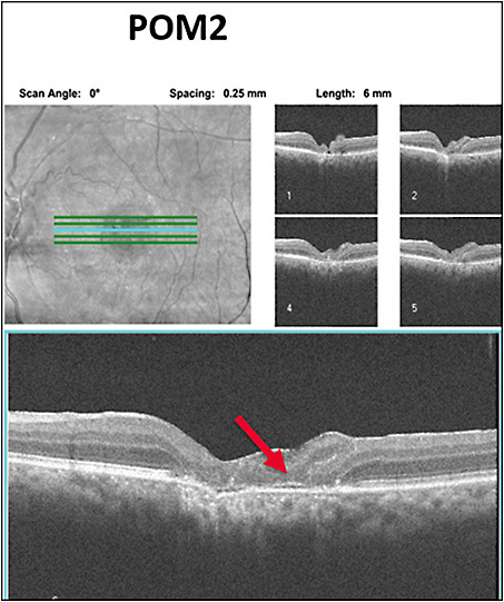 Retinal Physician | PentaVision