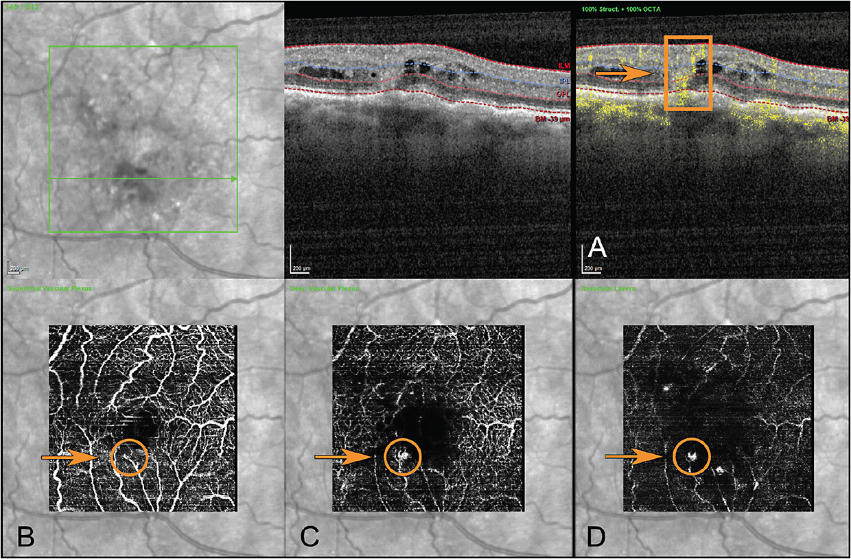 Retinal Physician | PentaVision