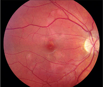 Retinal Physician | PentaVision