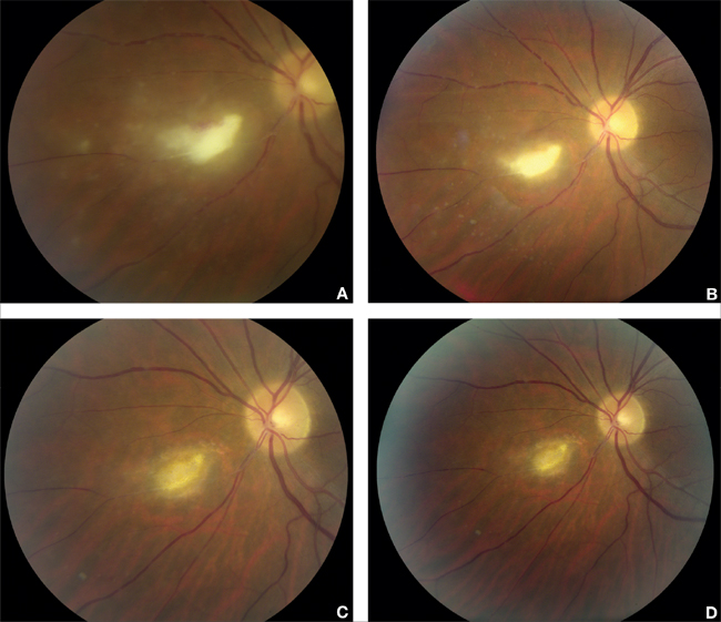 Retinal Physician | PentaVision