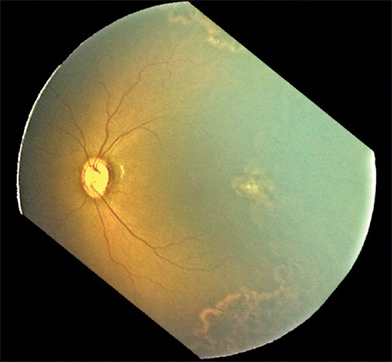 Retinal Physician | PentaVision