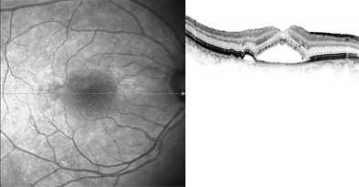 Retinal Physician | PentaVision