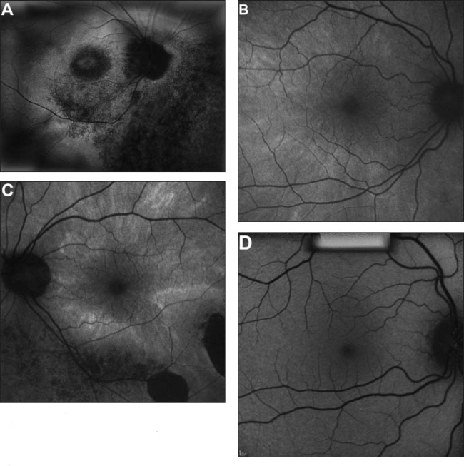 Retinal Physician | PentaVision