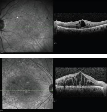 Retinal Physician | PentaVision