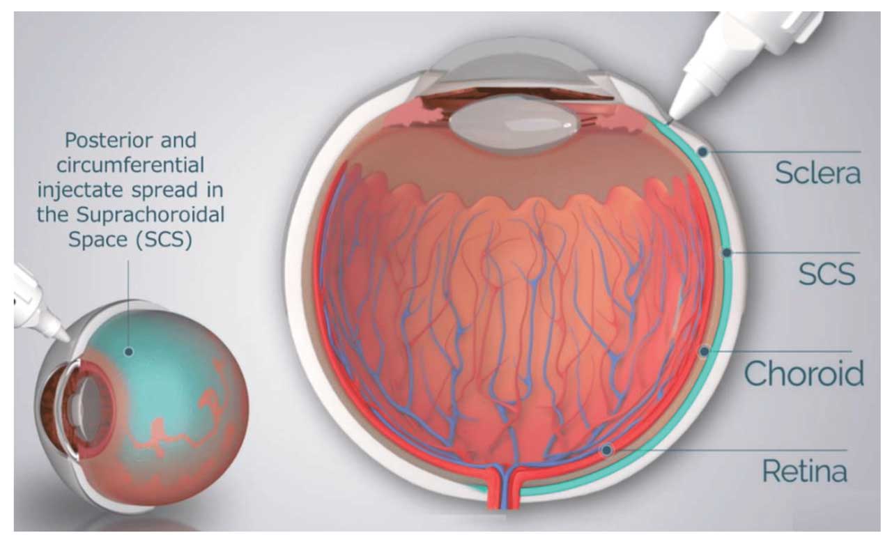 Expanding the Role of Suprachoroidal Injections | Retinal Physician