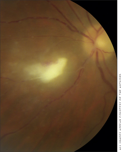 Retinal Physician | PentaVision