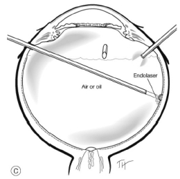 Retinal Physician | PentaVision