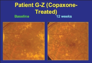 Retinal Physician | PentaVision