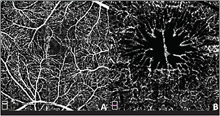 Retinal Physician | PentaVision