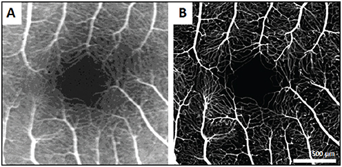Retinal Physician | PentaVision