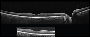 Retinal Physician | PentaVision