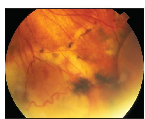 Retinal Physician | PentaVision