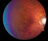 Retinal Physician | PentaVision