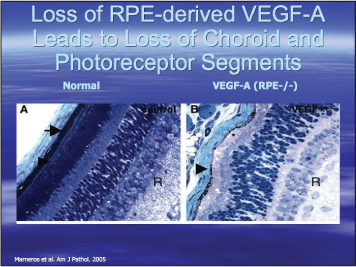 Retinal Physician | PentaVision