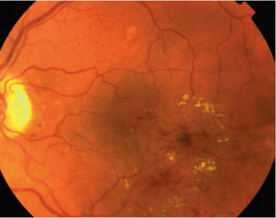 Retinal Physician | PentaVision