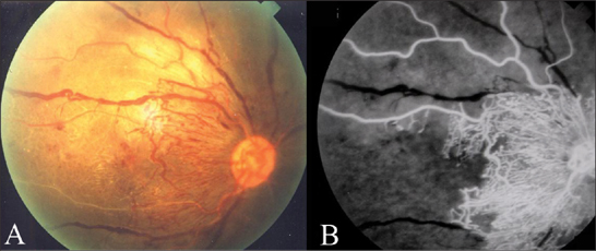 Retinal Physician | PentaVision