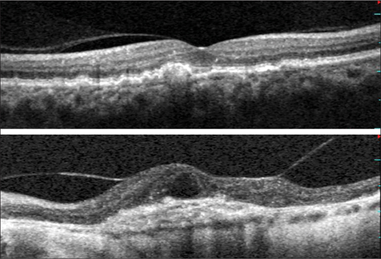 Retinal Physician | PentaVision