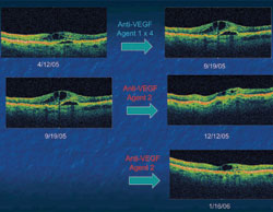 Retinal Physician | PentaVision