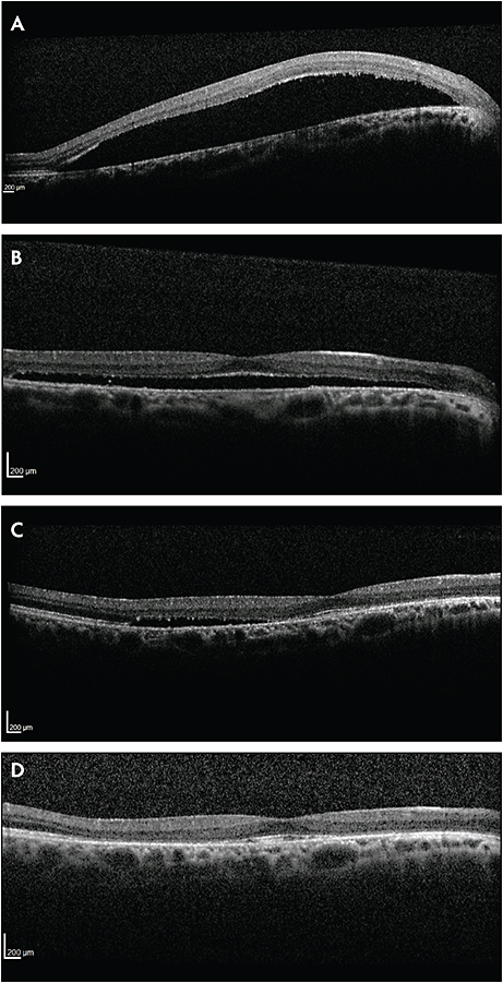 Retinal Physician | PentaVision