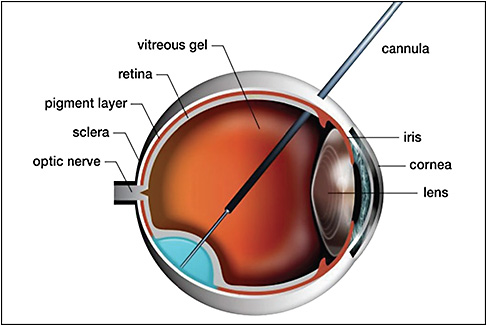 Retinal Physician | PentaVision