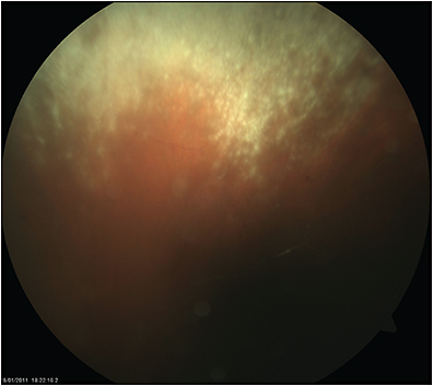 Retinal Physician | PentaVision