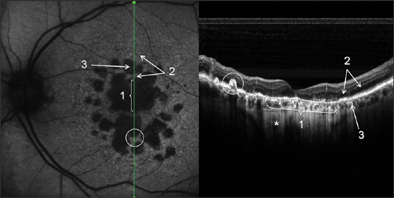 Retinal Physician | PentaVision