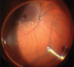 Retinal Physician | PentaVision