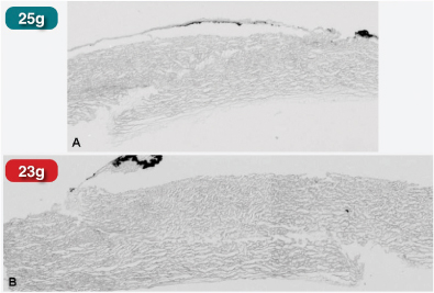 Retinal Physician | PentaVision