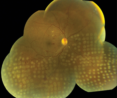 Retinal Physician | PentaVision