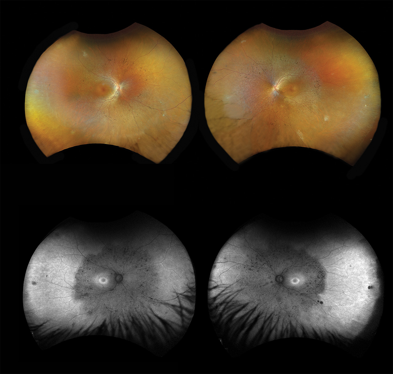Optos Ultra-Widefield Image of the Month | Retinal Physician