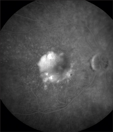 Retinal Physician | PentaVision