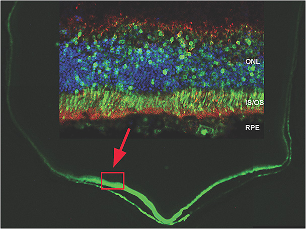 Retinal Physician | PentaVision