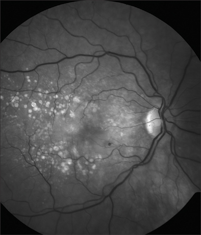 Retinal Physician | PentaVision