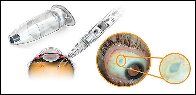 Retinal Physician | PentaVision