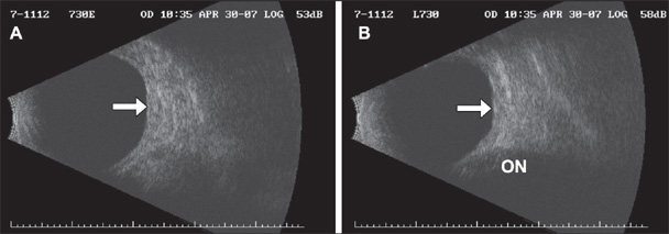 Retinal Physician | PentaVision
