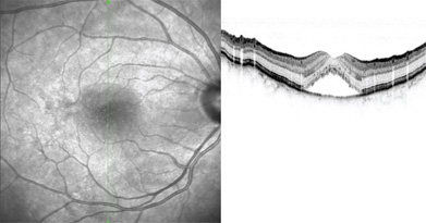 Retinal Physician | PentaVision