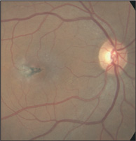 Retinal Physician | PentaVision