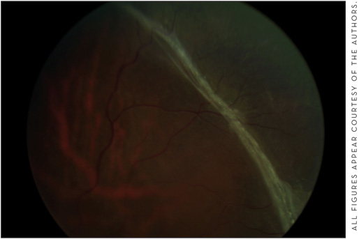 Retinal Physician | PentaVision