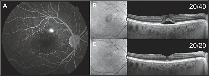 Retinal Physician | PentaVision