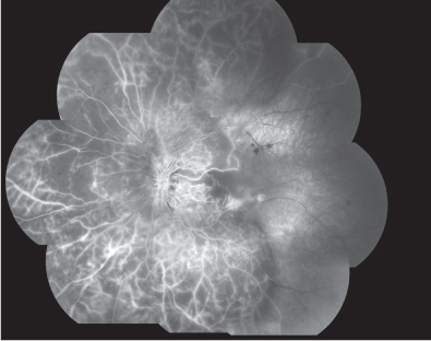 Retinal Physician | PentaVision