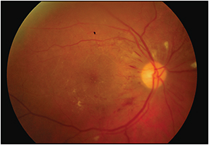 Retinal Physician | PentaVision
