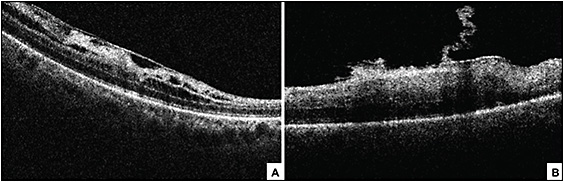 Retinal Physician | PentaVision
