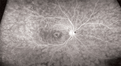 Retinal Physician | PentaVision