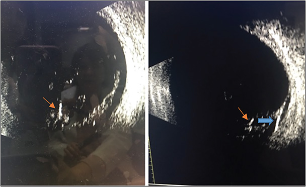 Retinal Physician | PentaVision