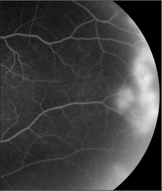 Retinal Physician | PentaVision
