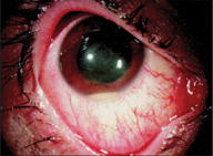 Retinal Physician | PentaVision