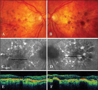 Retinal Physician | PentaVision